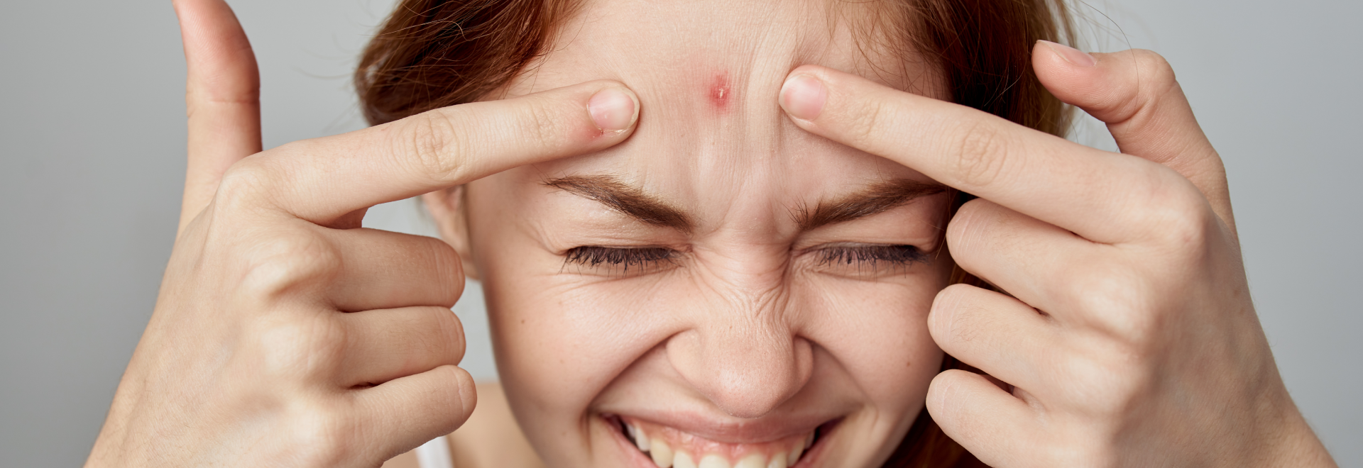 Evolving Acne Insights: The Roles of Sebum, Bacteria, and Inflammation ...